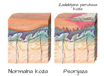 Psorijaza - uzroci i liječenje na prirodan način – Ivan Kunješić